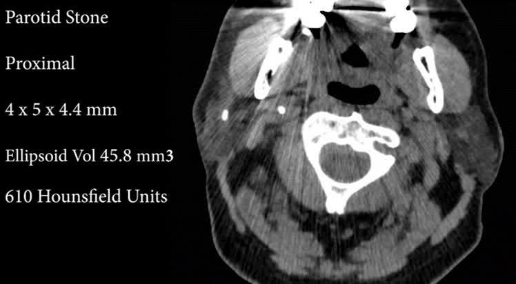 Right Parotid Stone Transoral Removal with Laser