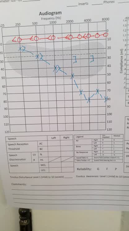 Explaining the audiogram - Mixed hearing loss