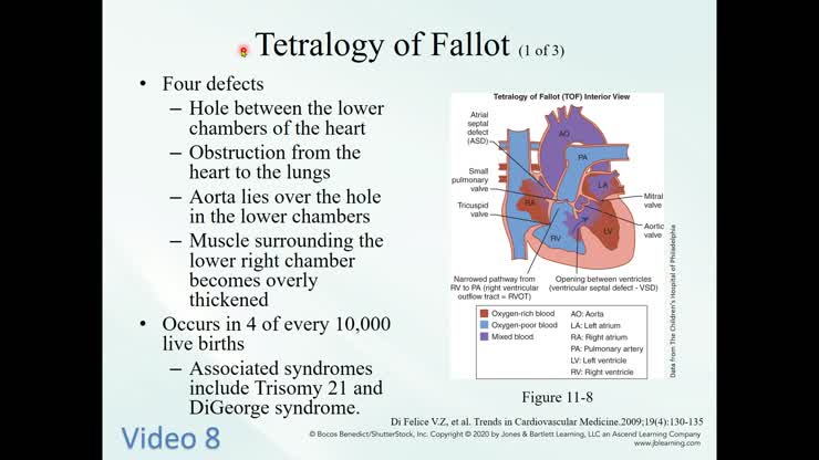 8. Tetrology of Fallot