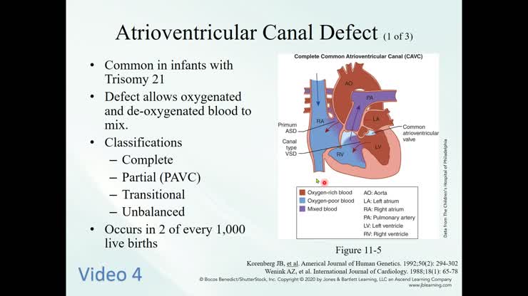 4. Atrioventricular Canal Defect