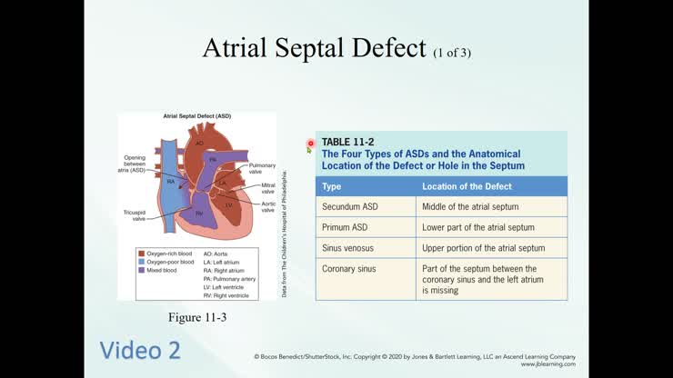2. Atrial Septal Defect