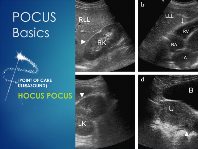 POCUS Basics