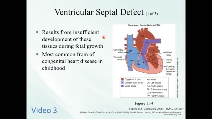 3. Ventricular Septal Defect