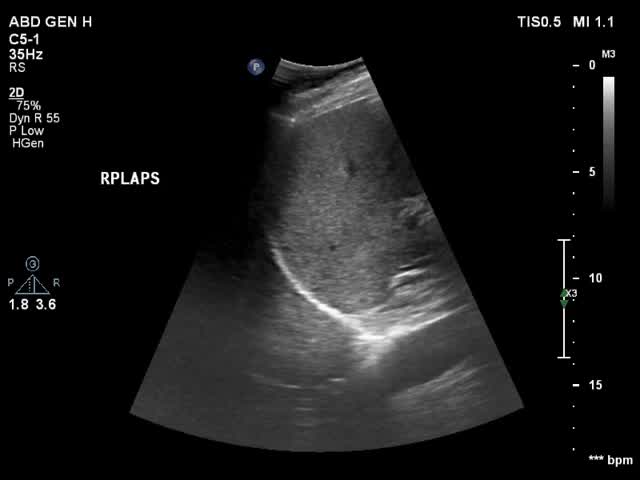 Lung Curtain