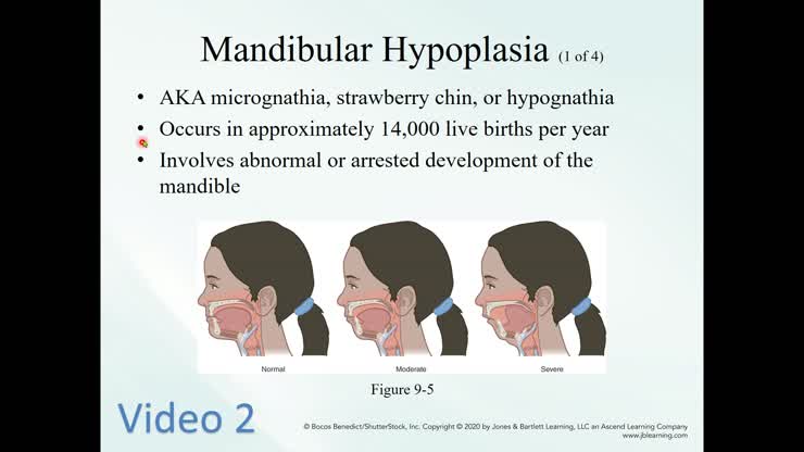 2. Mandibular Hypoplasia and Macroglossia