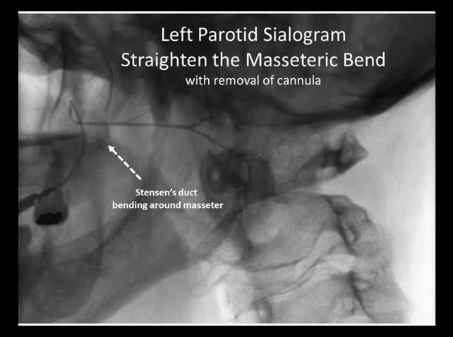 Sialogram Straighten Stensens Duct Around Masseter 11152021