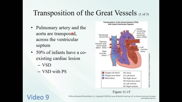 9. Transposition of Great Vessels