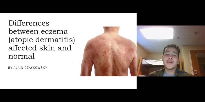 Differences between eczema (atopic dermatitis) affected skin and normal ...