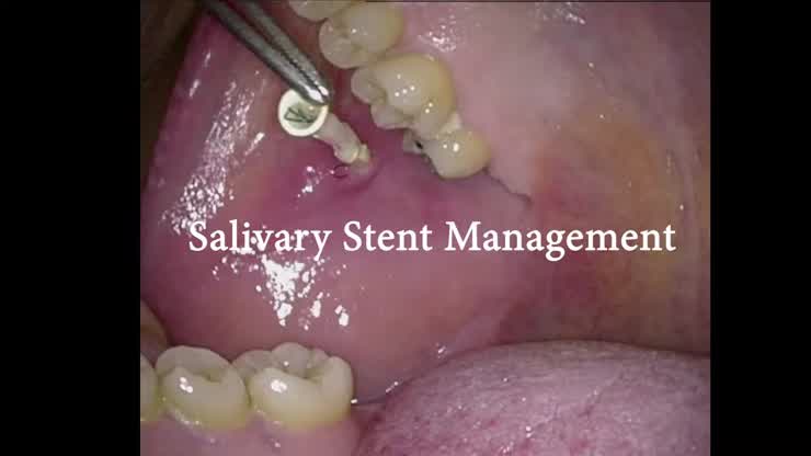 Stent management for parotid stricture