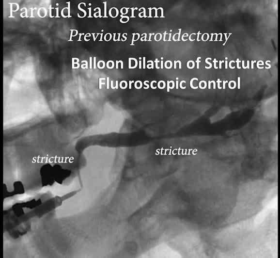 Parotid Duct Strictures Fluoroscopic Balloon Dilation