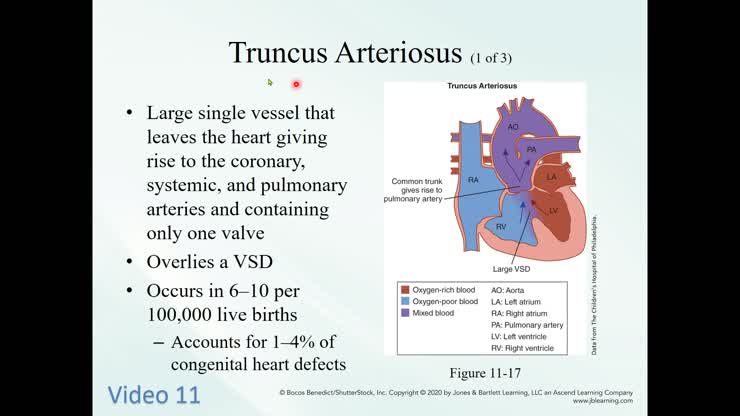 11. Truncus Arteriosus