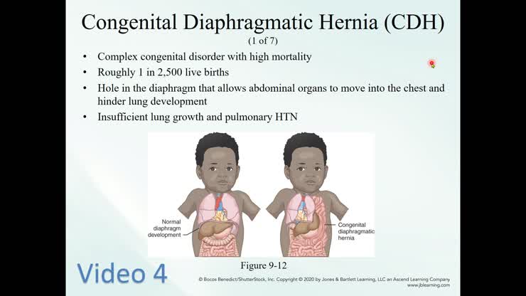 4. Congenital Diaphragmatic Hernia