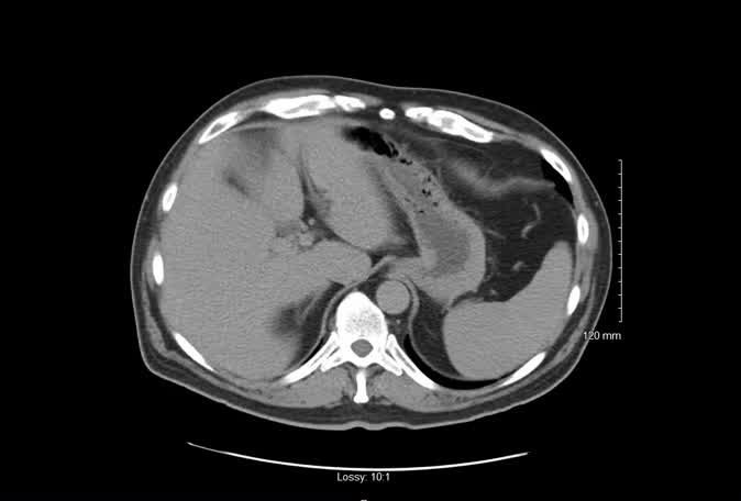 IVP CT TOMO - RENAL CYSTS