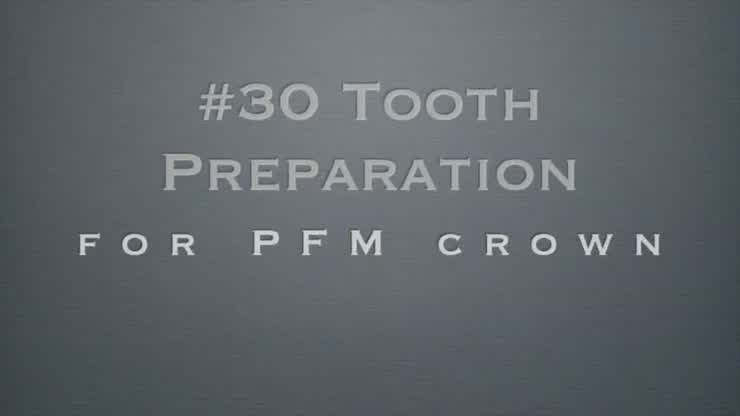 02-#30 PFM Crown Prep Tooth